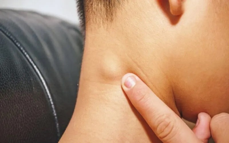 Ganglions gonflés : pourquoi cette boule apparaît au niveau du cou, de ...