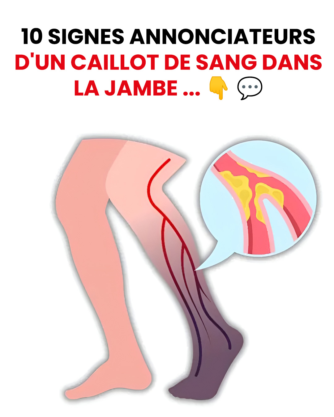 Les 10 principaux signes d’un caillot sanguin dans votre jambe ...