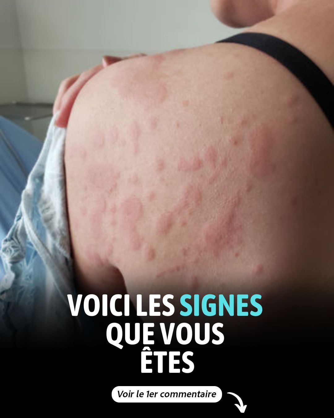Urticaire ? Allergie ? Tout son corps la démangeait, les médecins ...